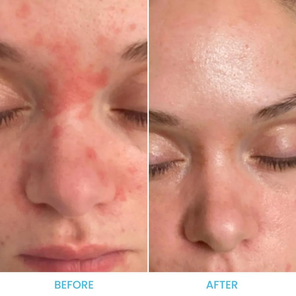 Grahams Natural Rosacea Cream 75g | Natonic